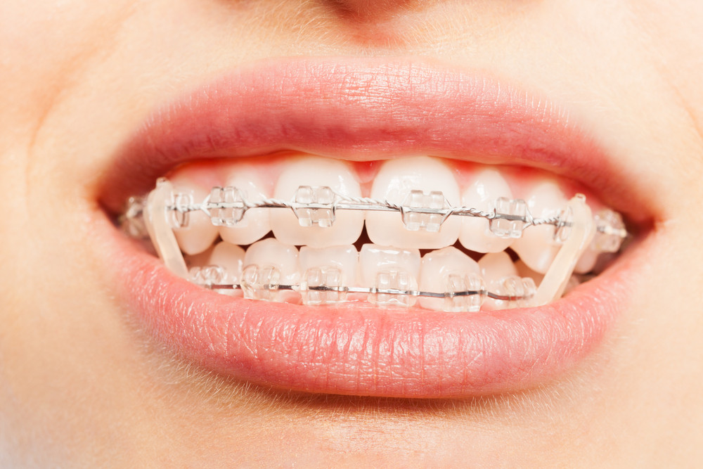 Elastics for Braces - Everything You Need to Know - Halgren Orthodontics
